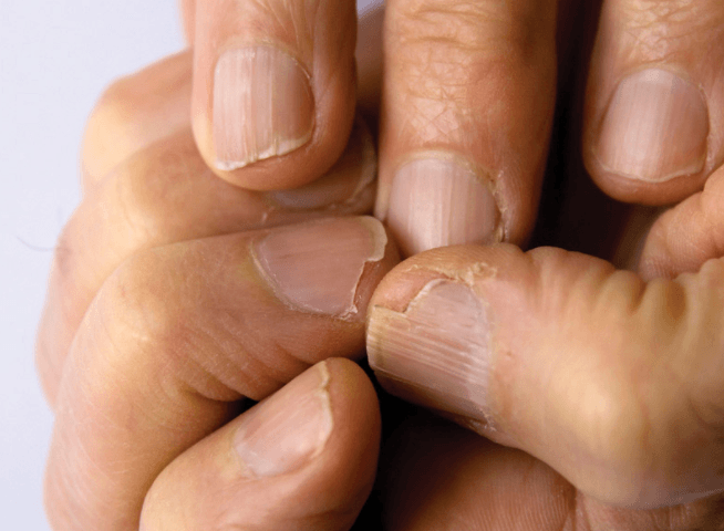 UNHAS DOENTES → Saiba o que fazer! Tratamentos e Sinais de Alerta