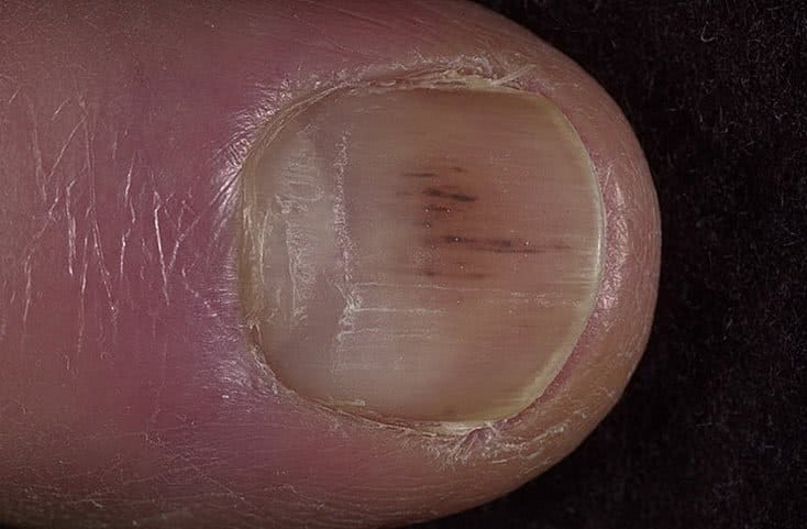 9 Sinais de Alerta para Saúde das suas Unhas e que podem indicar ...