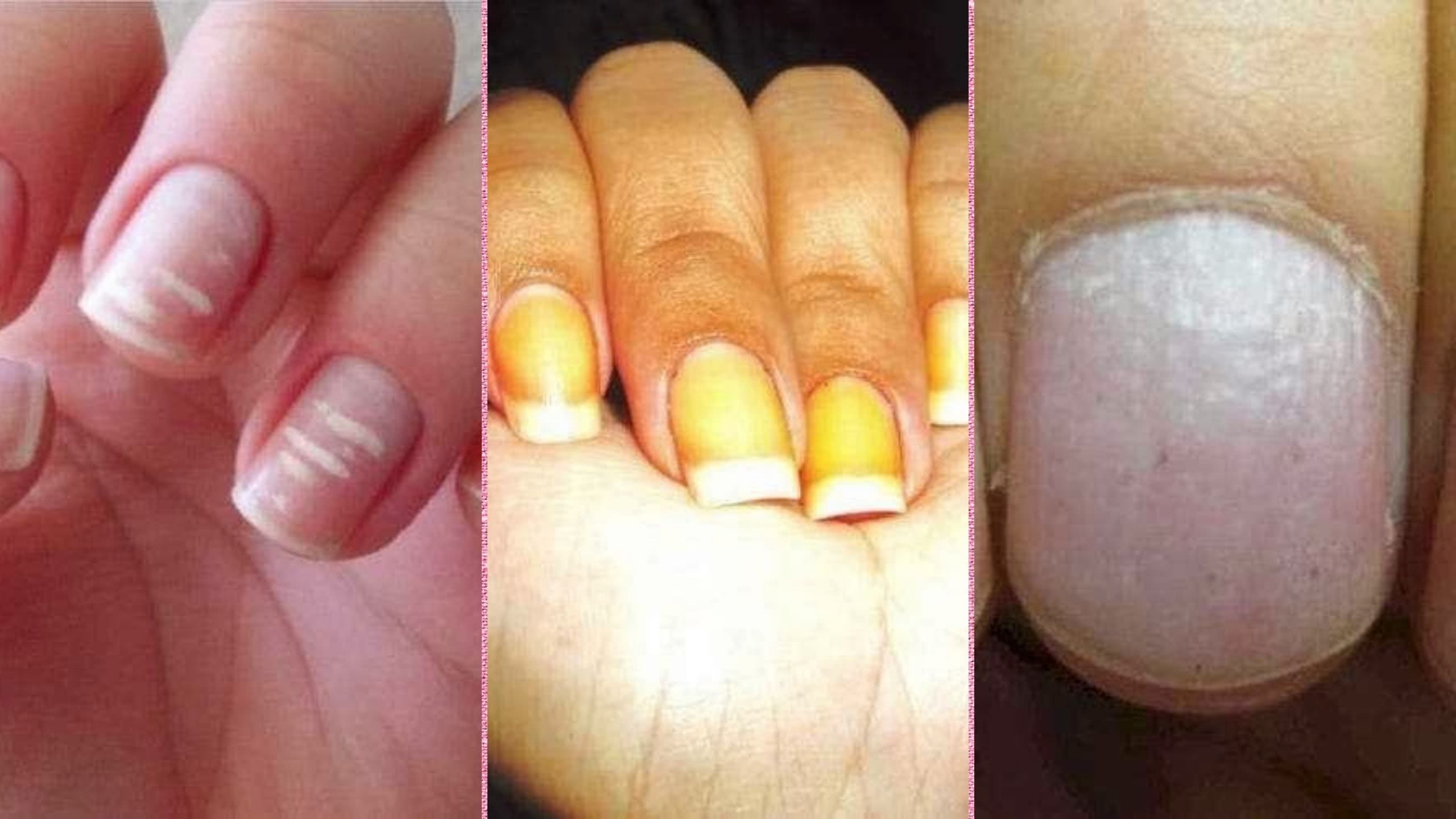 9 Sinais de Alerta para Saúde das suas Unhas e que podem indicar ...